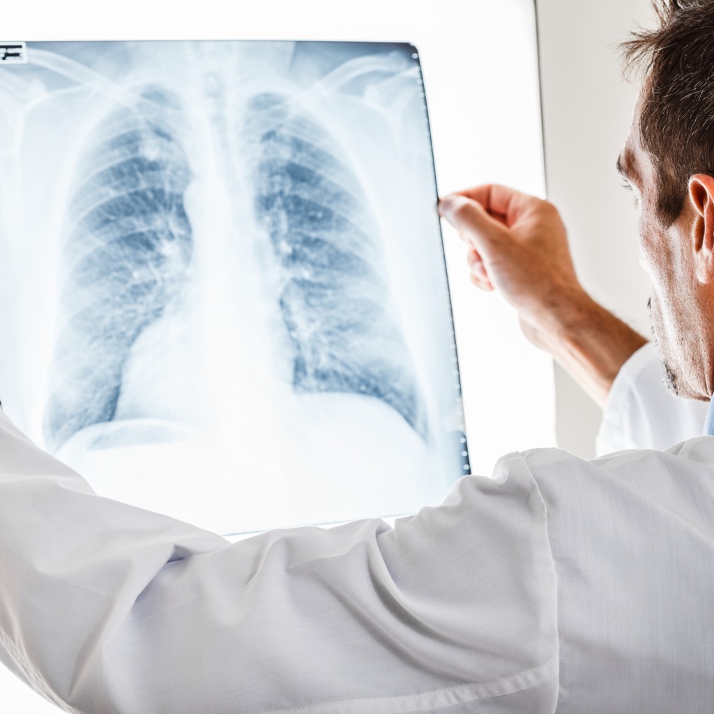 Lung Donors' Alcohol Habits Affect Recipient Recovery, Study Shows