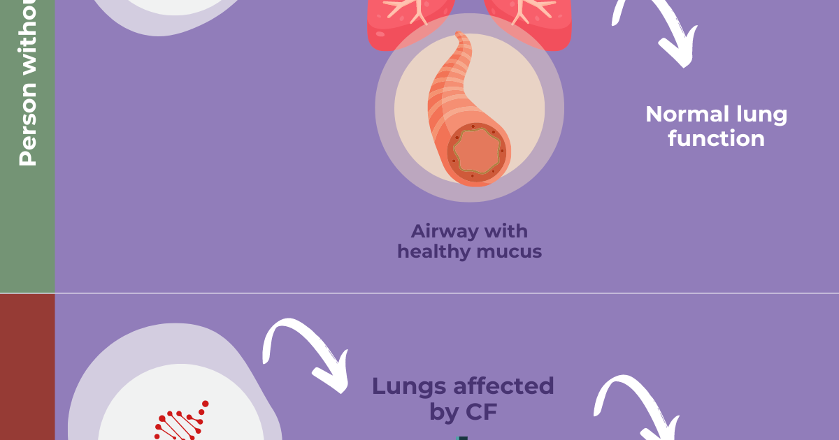 What is cystic fibrosis? | Cystic Fibrosis News Today